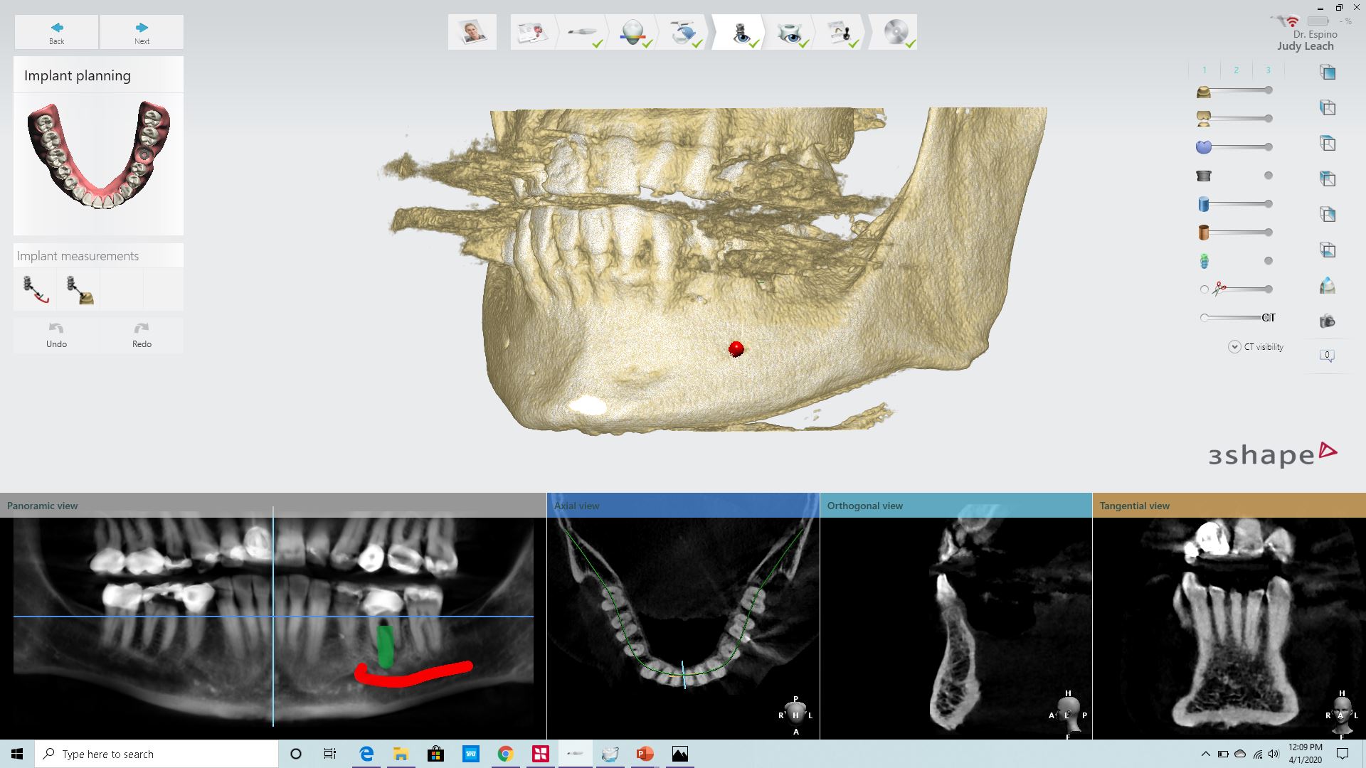 Digitally Guided Implants | Riverview Dental Arts