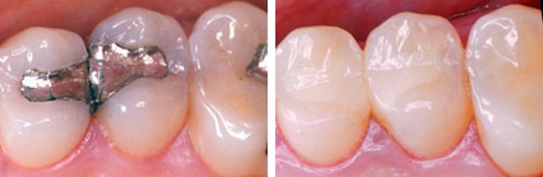 Composite Fillings in Riverview FL | Tooth-Colored Fillings